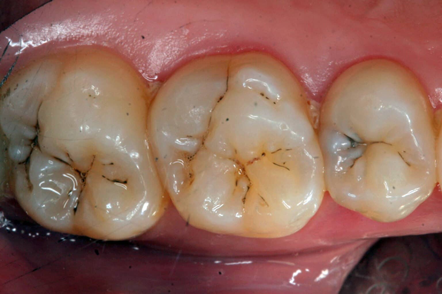 Caries diagnosis